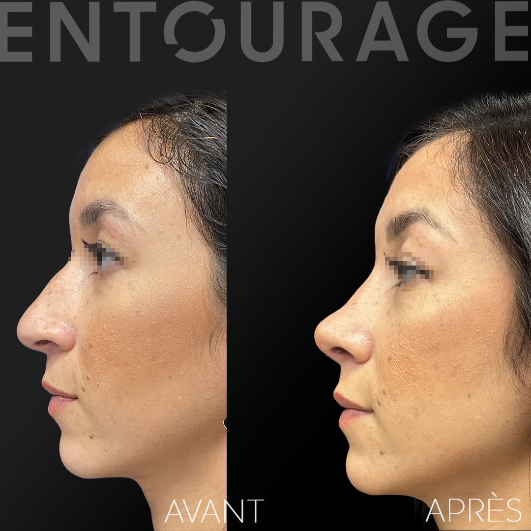 Rhinoplastie, chirurgie du nez à Lausanne - Nos tarifs
